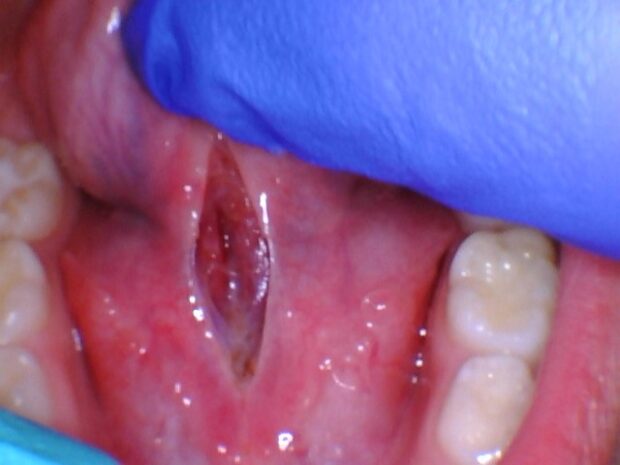 Before/After Pictures - Laser Tongue and Lip Tie Surgery Revision - Hudson Valley Pediatric ...