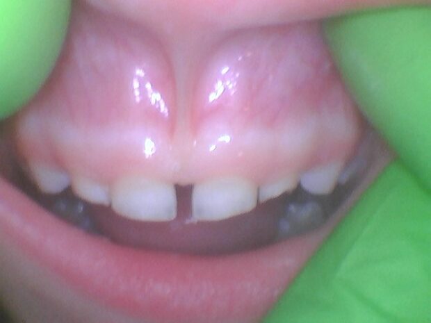 Frenectomy - Hudson Valley Pediatric Dentistry - Dentist Middletown, NY